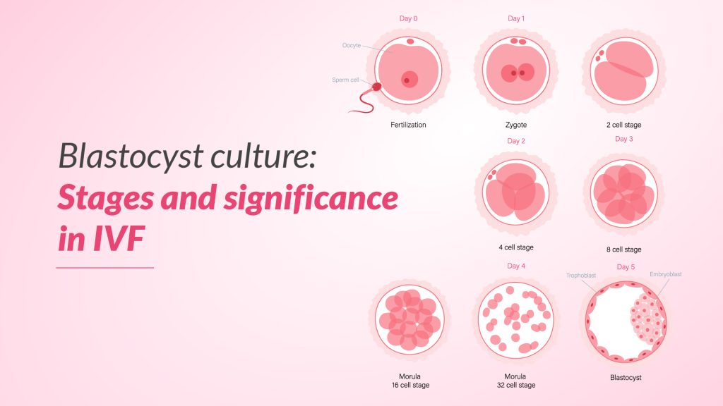 Blastocyst Culture in IVF: Stages & Its Key Role in Fertility Success