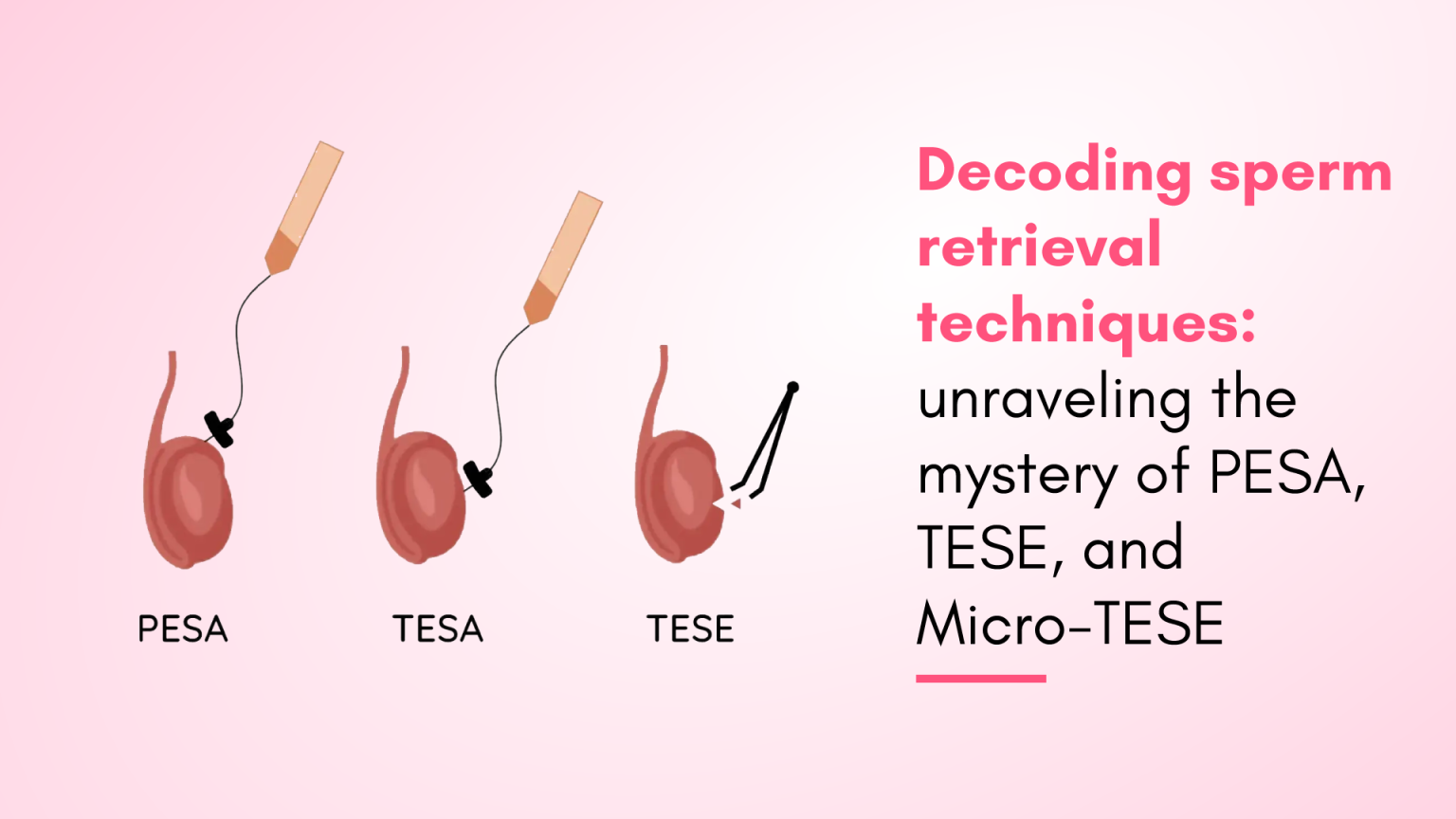 Sperm Retrieval Techniques: What is PESA, TESE, & Micro-TESE?