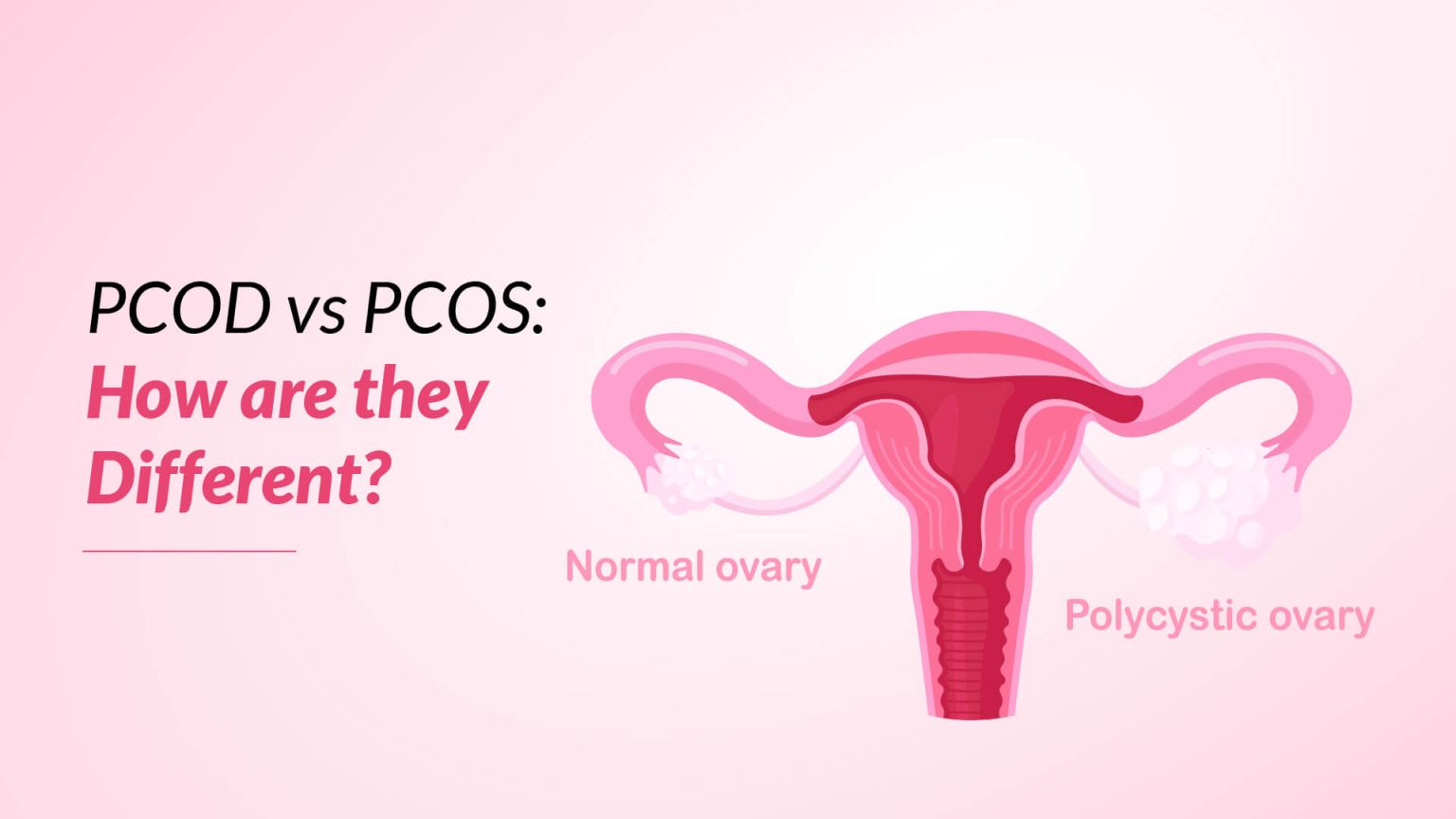 PCOD vs PCOS: Understanding Symptoms, Causes & Differences