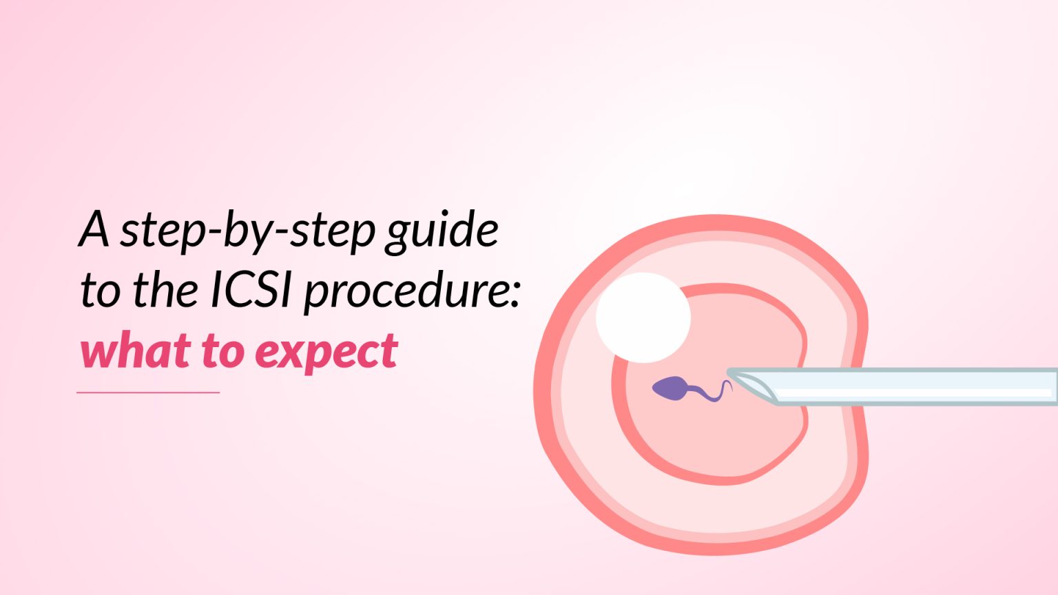 A Complete Step-by-Step Guide to the ICSI Procedure
