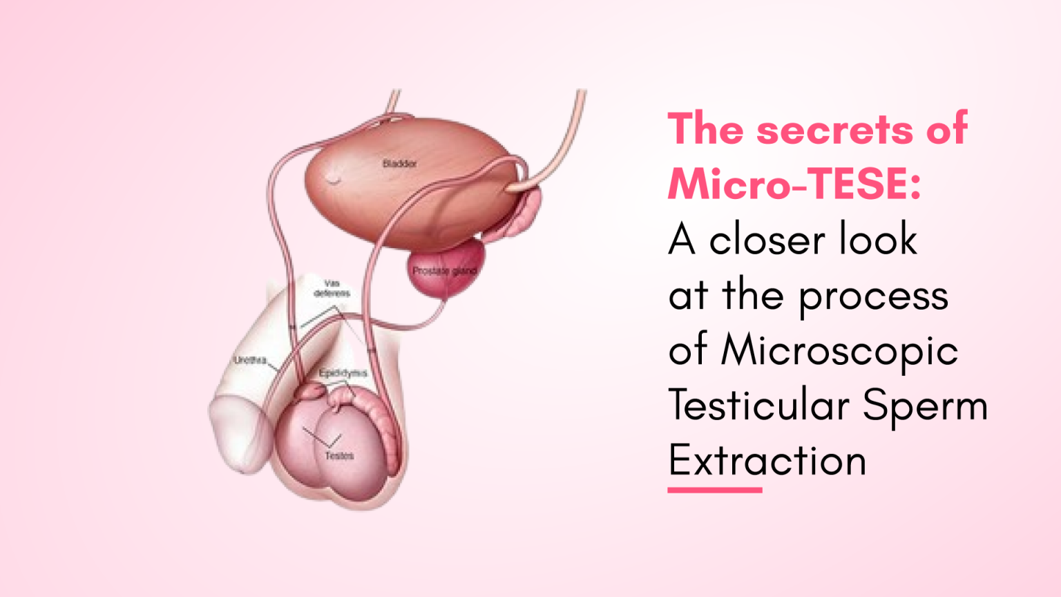 Micro-TESE: The Process of Testicular Sperm Extraction