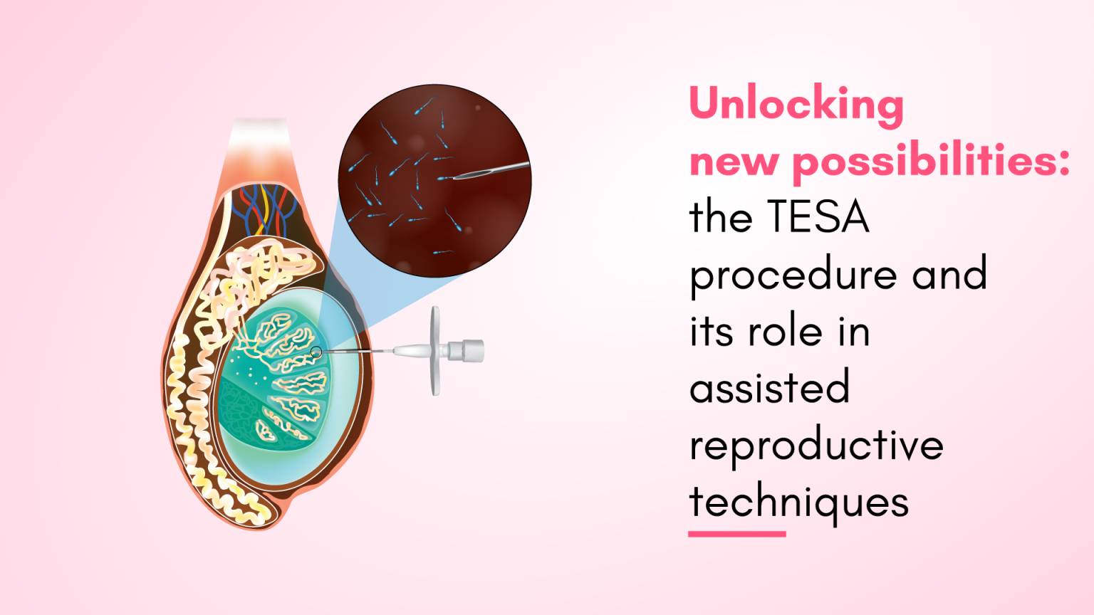 TESA Procedure & Its Role in Assisted Reproductive Techniques